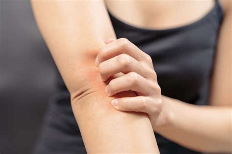 Nummular Eczema 10 Symptoms Of Nummular Eczema