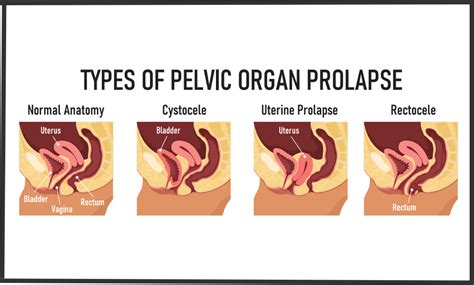 Uterine Prolapse Symptoms