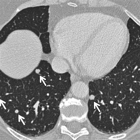 Pdf Guidelines For Management Of Incidental Pulmonary Nodules Detected On Ct Images From The
