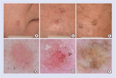 Can Keratosis Turn Into Melanoma At Lindsey Vann Blog