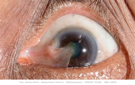 Doenca Ocular Do Pterigio Pterígio é Um Tumor