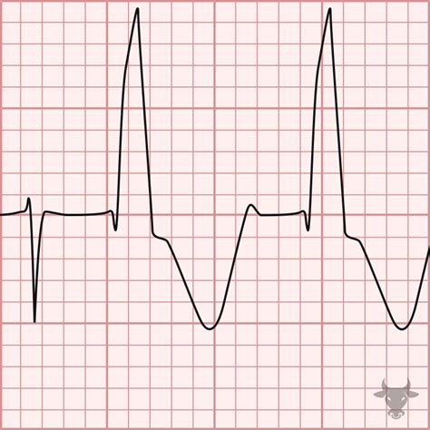 Ashman Phenomenon Ecg Stampede