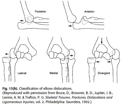 Classification Of Elbow Dislocations Orthopaedicsone Articles