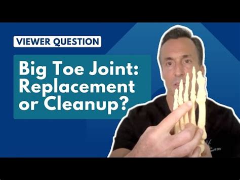 How Long Does A Big Toe Artifical Joint Replacement Last