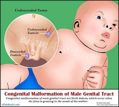 Congenital Malformation Of Male And Female Genital Tract