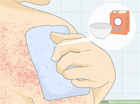 How To Treat Heat Rash 14 Steps With Pictures Wikihow Health