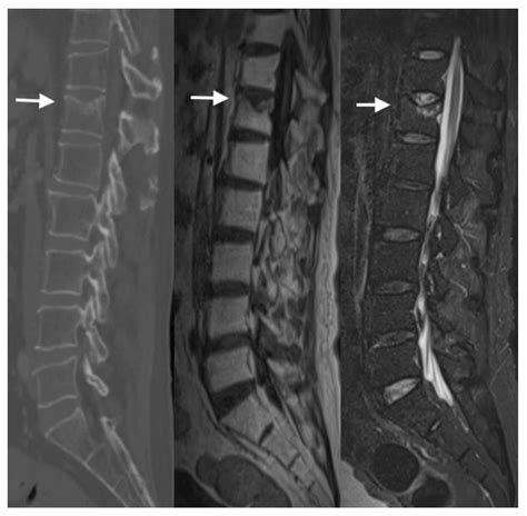 Radiological Diagnosis And Advances In Imaging Of Vertebral Compression
