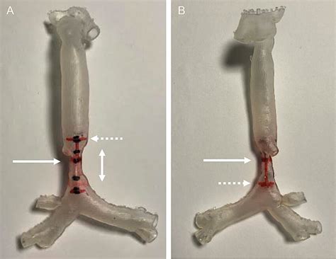 Designing The Incision Route Using A 3d Trachea Model Case 1 A