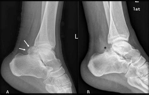 Síndrome De Impacto Posterior Del Tobillo Sipt Asociado A “proceso De
