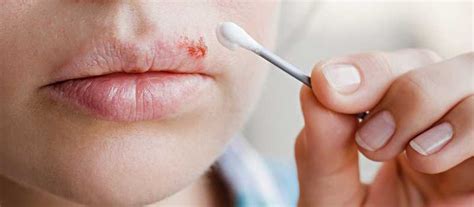 21 Natural Essential Oils For Cold Sores And How To Use Them