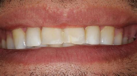 How To Get Rid Of White Spots On Your Front Teeth Easily And Pain Free