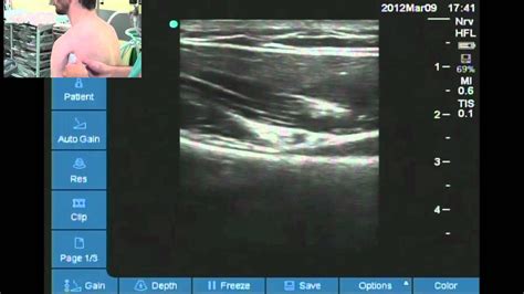Axillary Nerve Block