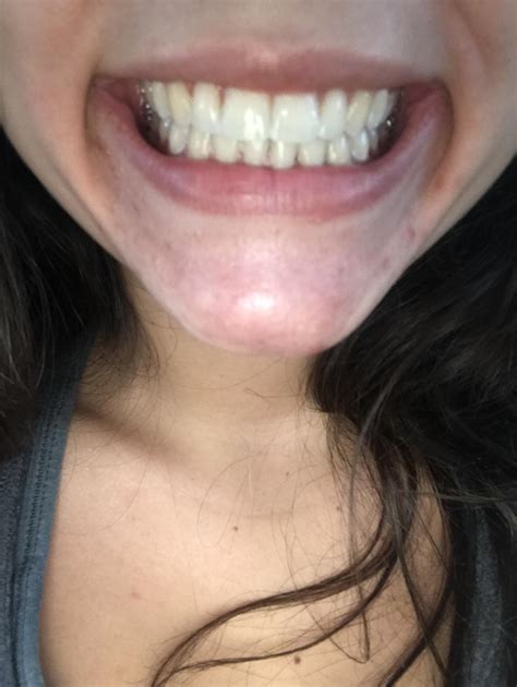 Its My Birthday And I Got My Braces Off R Braces