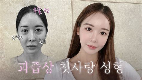 복숭아 같은 과즙미🍑 팡팡 터지는 과즙상 성형 피곤하고 불만가득 인상에서 생기발랄한 이미지로 대변신 Youtube