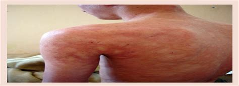 Diffuse Cutaneous Leishmaniasis Presenting As Erythroderma Acta