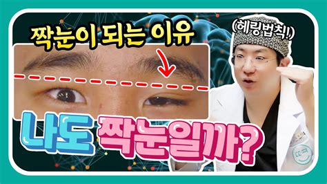 Eng 눈 성형만 일곱 번 쌍꺼풀수술 계속하게 되는 이유 짝눈 교정 헤링의 법칙 Youtube