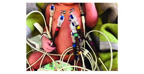 Positioning Of Electrocardiogram Electrodes In Newborns Download