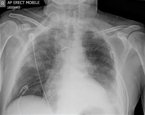 Right Ventricular Laceration Caused By Sternal Wire Fracture Following
