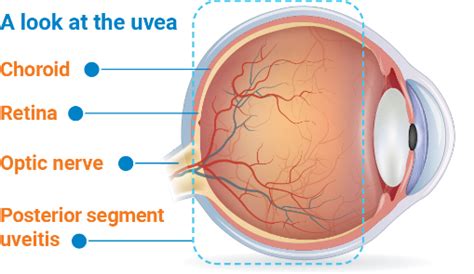 Uveitis