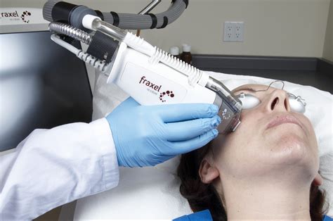 Fraxel Skin Resurfacing™ Laser Spa Group