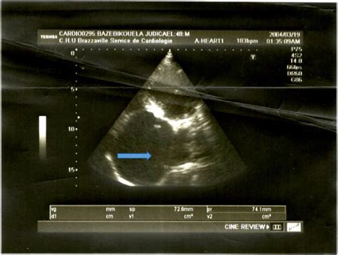 Cardiac Echocardiography Parasternal Long Axis Section Aortic
