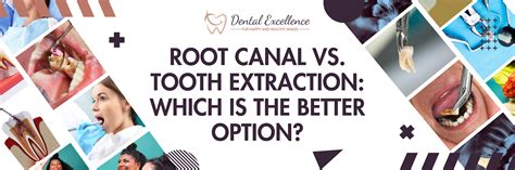 Root Canal Vs Tooth Extraction Which Is The Better Option