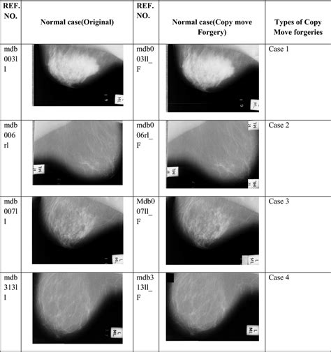 Normal Image In Original And Forged Mias Dataset Mammograms