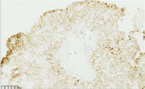 Immunohistochemical Stain P504s Is Positive In The Membrane Of Download Scientific Diagram