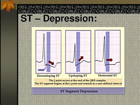 Ppt Wrappin Up Rhythm Ecg That Is Powerpoint Presentation Free
