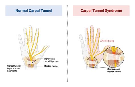Carpal Tunnel Syndrome Biorender Science Templates