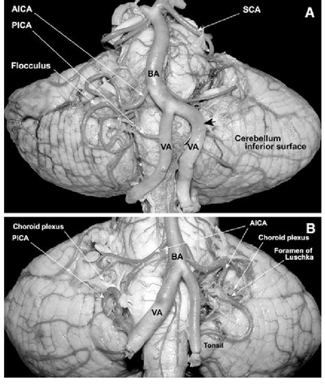 Superior Cerebellar Artery Function