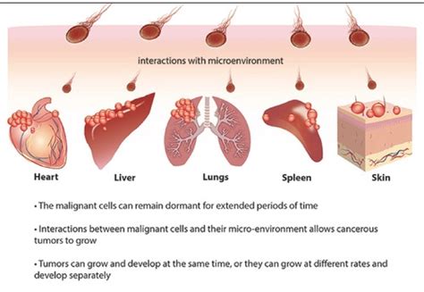 22 Hemangiosarcoma Flashcards Quizlet