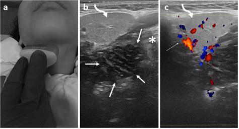 Peritonsillar Abscess X Ray Peritonsillar Abscess X Ray