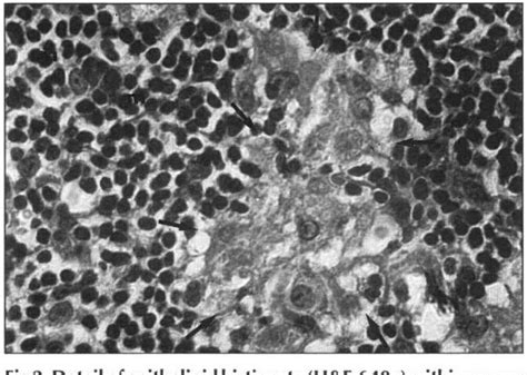 Figure 1 From Acquired Toxoplasmosis Of A Submandibular Lymph Node In A