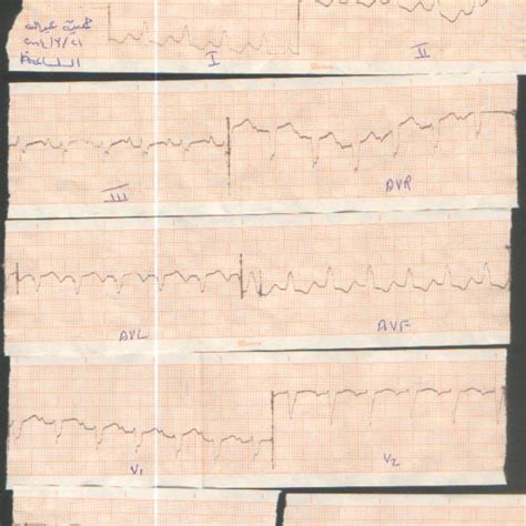Ecg Showed Evidence Of Lbbb Download Scientific Diagram
