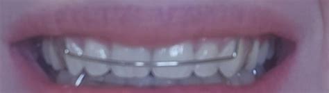 I Got My Braces Removed Rbraces