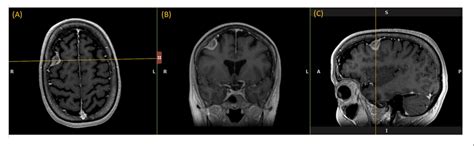 Figure From Measuring Efficiency Of Semi Automated Brain Tumor Segmentation By Simulating User