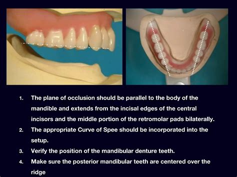 7 Try In Of The Wax Trial Complete Denture Ppt
