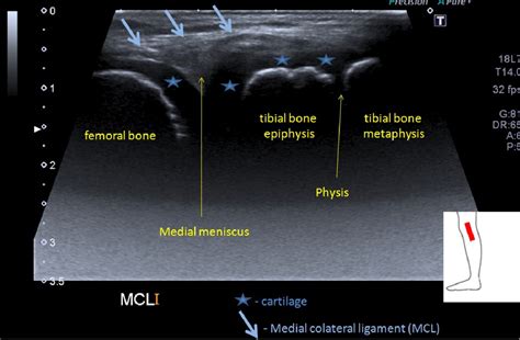 Figure 3 From Knee Ultrasound In Pediatric Patients Anatomy