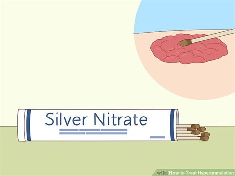 8 Ways To Treat Hypergranulation Wikihow Health