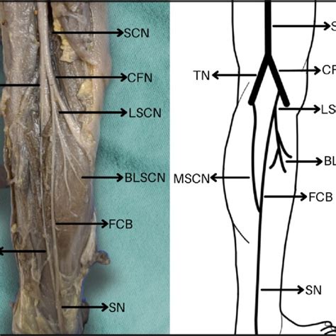 The Eight Sn Formation Patterns Scn Sciatic Nerve Tn Tibial Nerve