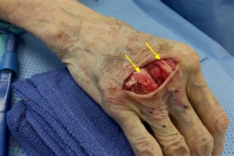 Extensor Tendon Subluxation Finger Hand Surgery Resource