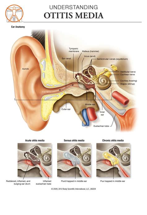 Otitis Media Anatomical Wall Chart Bsi Catalog