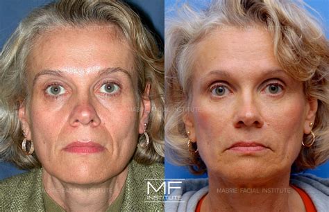 Nasolabial Folds Before And After Pictures Case 897 San Francisco Ca