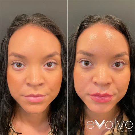 Versa Filler For Lips Before And After Evolve Med Spa