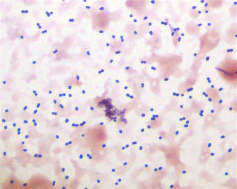Pneumococcae In A Gram Preparation Doccheck