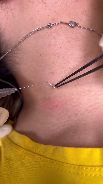 Skin Tag اسکین تگ Skintags Wartstreatment Plasma Mole فیشیال خال Youtube