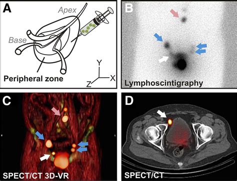 Meaning Of Stratification For Sentinel Lymph Node Biopsies