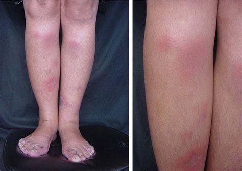 Paniculitis Por Frío O Enfermedad De Haxthausen O De Los Helados Farmaconsejos