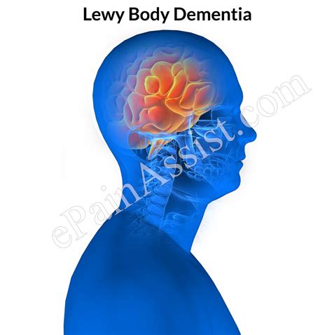 Lewy Body Dementiasymptomscausesdiagnosistreatment Medication Therapies
